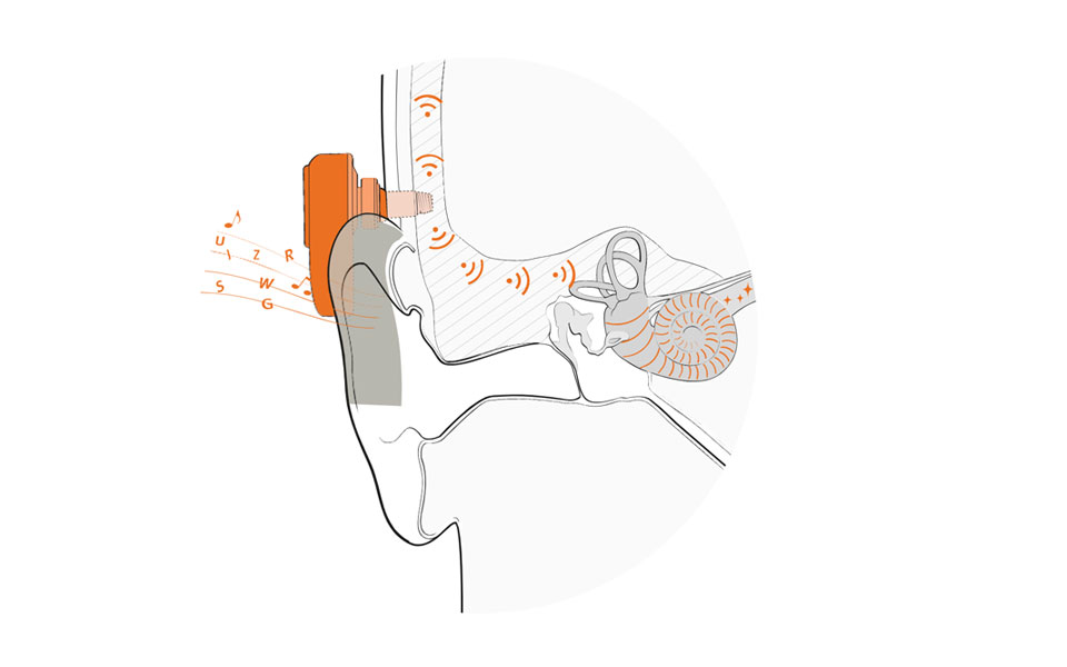 Bone conduction step-by-step