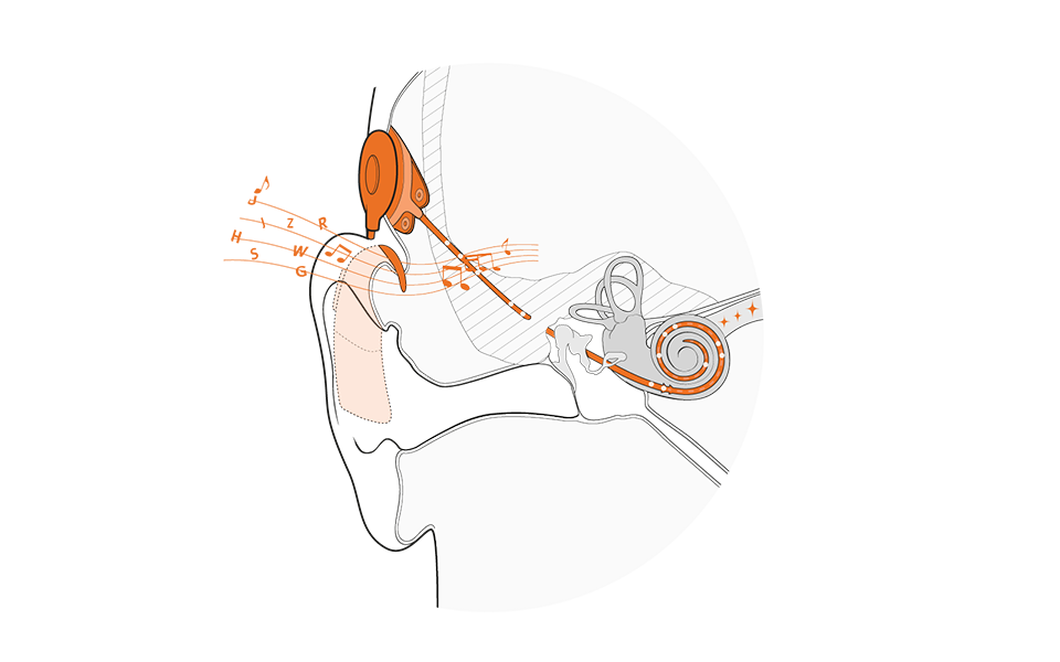 Cochlear implant user journey