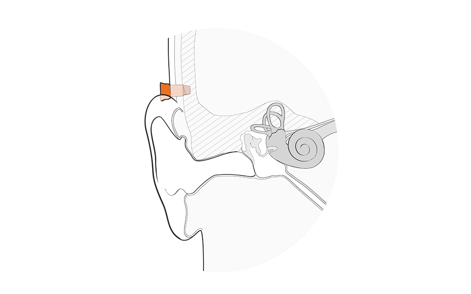 Bone conduction step-by-step