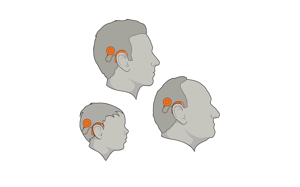 Cochlear implant user journey