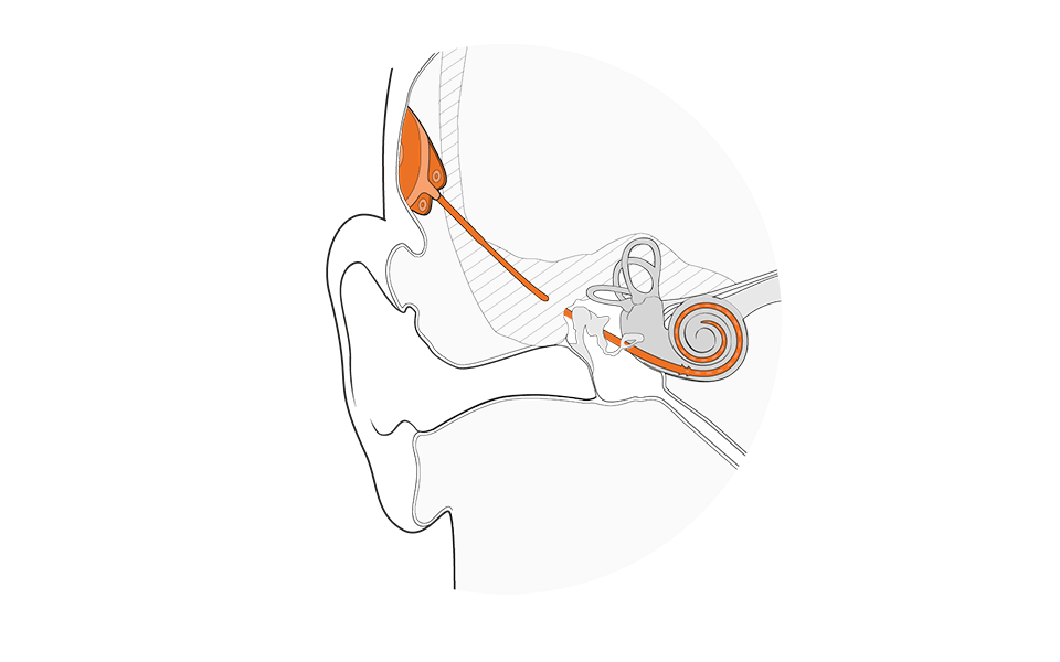 Cochlear implant user journey